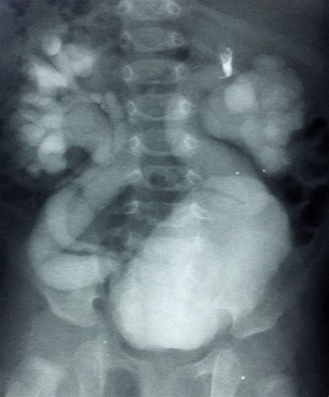 Urography Showing Complete Right Pyeloureteral Duplication And Download Scientific Diagram