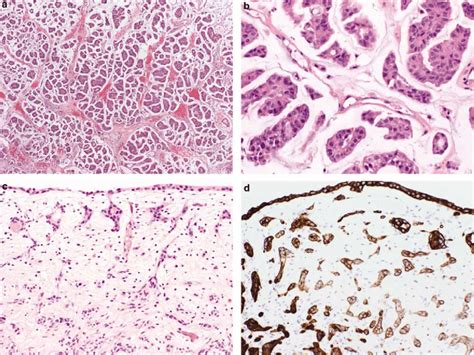 Micropapillary A And B And Nested C And D Variants Of Urothelial