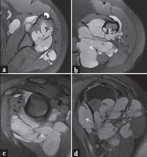 Plexiform Neurofibroma In The Axilla With Intraosseous Neurofibroma In