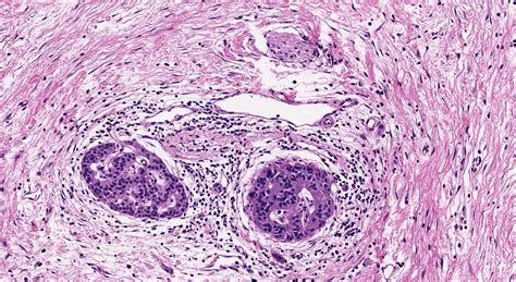 Pathology Outlines Chronic Pancreatitis Hot Sex Picture