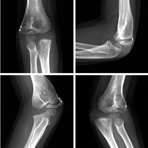 Measurement Of The Displacement In The Anteroposterior Lateral And Download Scientific Diagram