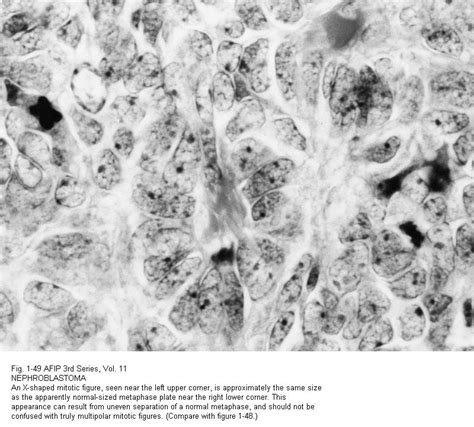 Pathology Outlines Nephroblastoma Wilms Tumor