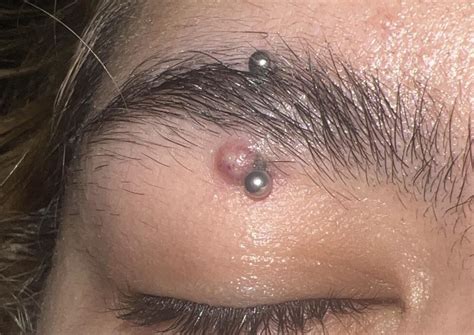 Eyebrow Bump… Infected Or Rejecting R Legitpiercing