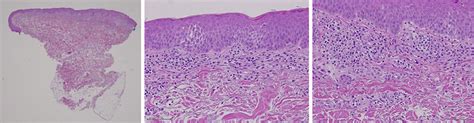 Histopathological Findings Taken From The Trunk At The First Visit A