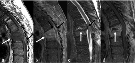 Spondylodiscitis In A 57 Year Old Woman A Sagittal T1 Weighted Image
