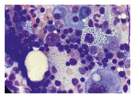 Bone Marrow Biopsy With Foamy Mott Cells On A Hande Immunostain For B Download Scientific