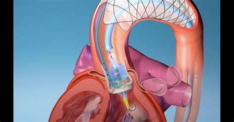 Interventional Cardiologists Perform Worlds First Tavr With New