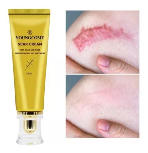 Pomada Gel Tira Remove Cicatriz Queloide Youngcôme 15ml MercadoLivre