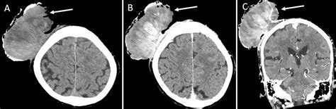 A 67 Year Old Man With A Right Parietal Scalp Tumor With Histologically