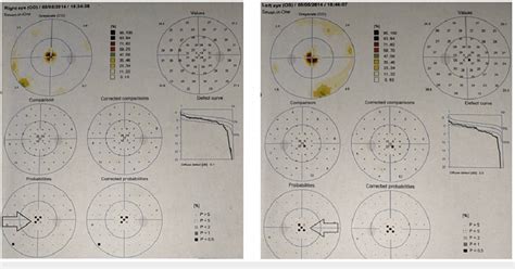 Perimetry Examination Of Right And Left Eye Download Scientific Diagram