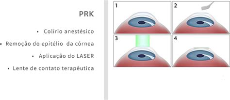 Cirurgia Refrativa Iou Instituto De Olhos Uberaba