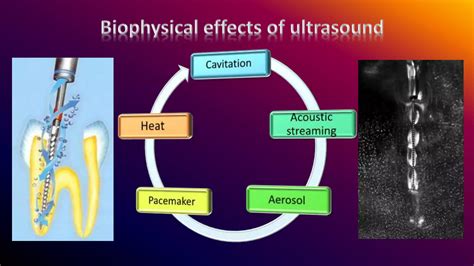 Ultrasonics In Endodontics Pptx