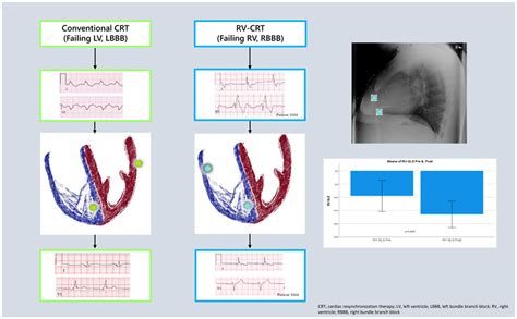 Right Ventricular Cardiac Resynchronization Therapy In Patients With