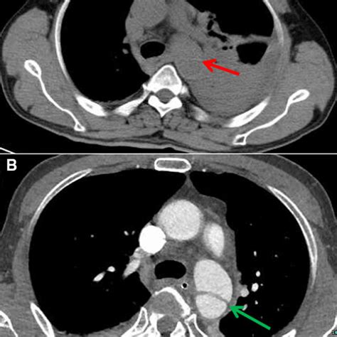 Chest Ct Imaging Scan Of Case 2 A The Mediastinal Space Is Slightly