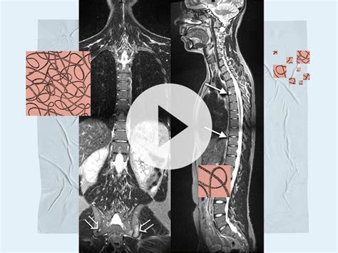 Ankylosing Spondylitis As Symptoms Early Signs And More