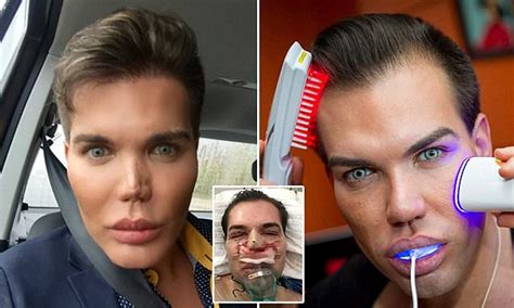Surgery Addict Rodrigo Alves To Get A £50000 Nose On The Nhs After