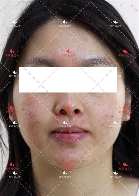 吃着异维a酸的痘痘肌姑娘，该怎么办 知乎