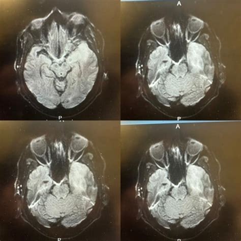 Ive Got Herpes On The Brain A Case Of Hsv Encephalitis Emra