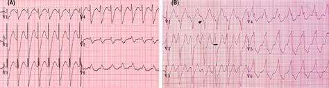 A Svt With Left Bundle Branch Block Morphology There Is A Narrow