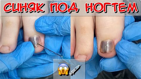 Игла под ноготь Синяк под ногтем Гематома под ногтем Youtube