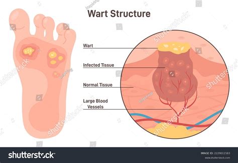 201 Types Warts Images Stock Photos Vectors Shutterstock