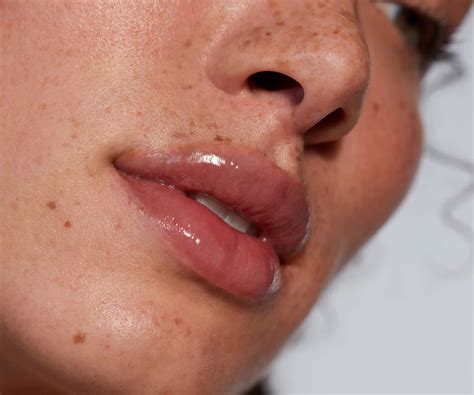 Collection Of Dermal Fillers JuvÉderm® Official