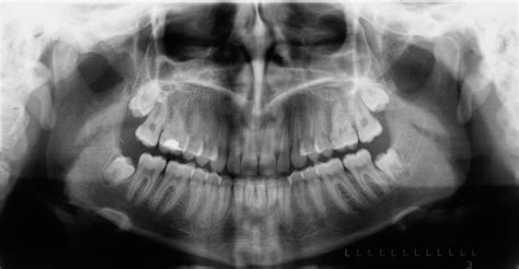 Paranasal Sinuses Radiograph Showing Hypoplastic Maxillary