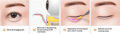 Remove Under Eye Bags Without Surgery