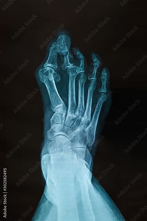 X Ray Of The Right Foot Transverse Plane Deviation Crossover Second