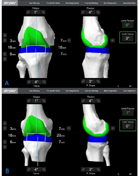 Intraoperative Determination Of The Stressed Hip Knee Ankle Angle