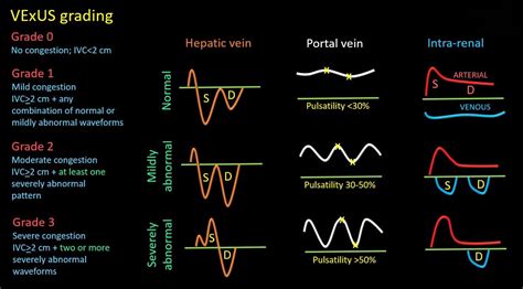 Pocus Spotlight Venous Excess Ultrasound Score Vexus