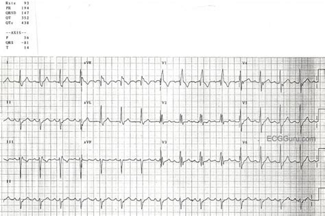 Right Bundle Branch Block With Left Anterior Fascicular Block Ecg Guru Instructor Resources