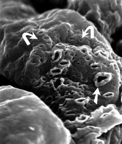 Segmental Membranous Glomerulonephritis Shows Craters Eyescandy