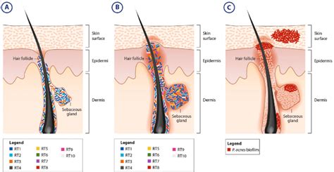 Propionibacterium Acnes