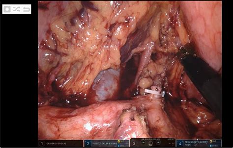 Robotic Lymph Node Dissection Of The Celiac Trunk Station 9 The Download Scientific Diagram