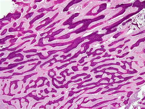 Pathology Outlines Parosteal Osteosarcoma
