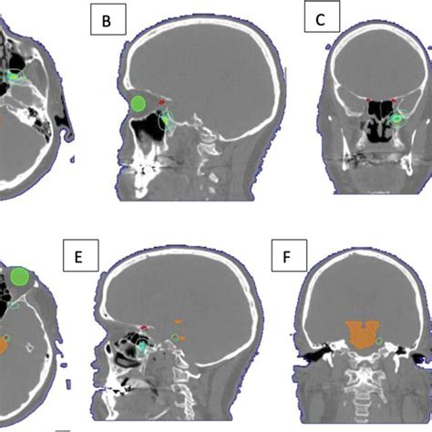 Treating Sunct With Radiosurgery A Case Report And Updated Literature