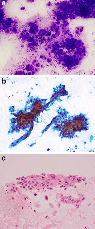 A Diff Quick Stained Aspirate Smear Shows Malignant Squamous Cells