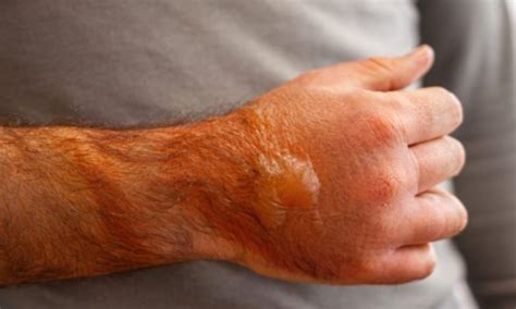 First Aid Poisoning Differences Between Acid And Alkaline Burns