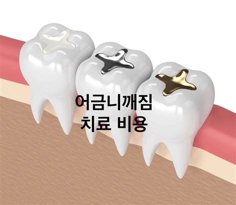 어금니 깨짐 치료 비용