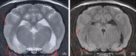 A T2w And B Flair Images Demonstrating Diffuse T2wflair