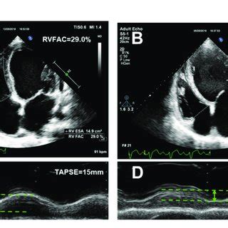 Representative Examples Of RVFAC And TAPSE Measurement From Patients Download Scientific