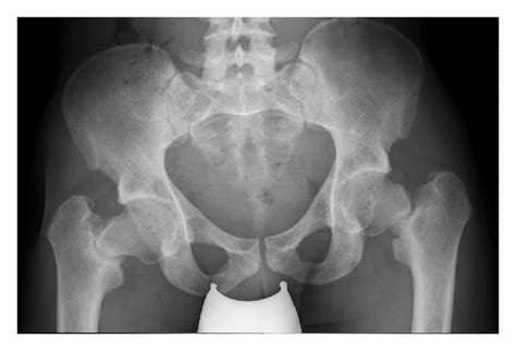 Standard Pelvic Radiograph Showing Bilateral Pseudarthrosis Of The Download Scientific Diagram