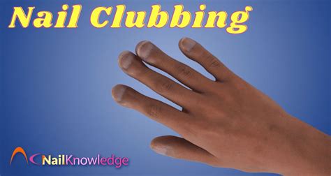 What Is Clubbed Finger