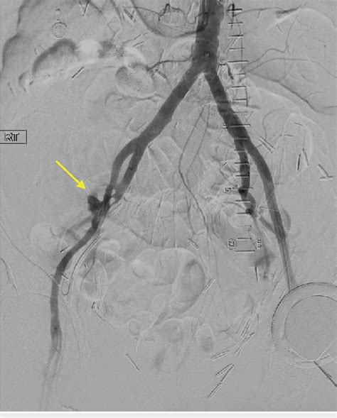 Active Contrast Extravasation Arrow Was Observed From The Mid Right