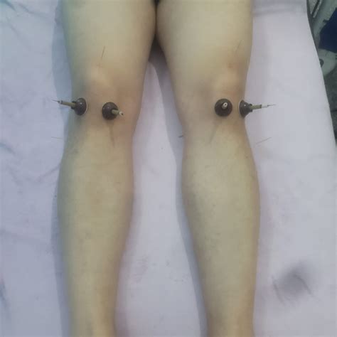 Эмчилгээний явцаас шивүүртөөнө Нархан уламжлалт бариа засал