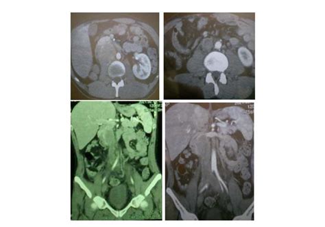 Aandbandcandd Postoperative Ct Images Showing Tumor Recurrence In The Renal
