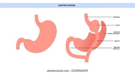 64 Bypass Gastric Procedimiento Stock Vectors And Vector Art Shutterstock