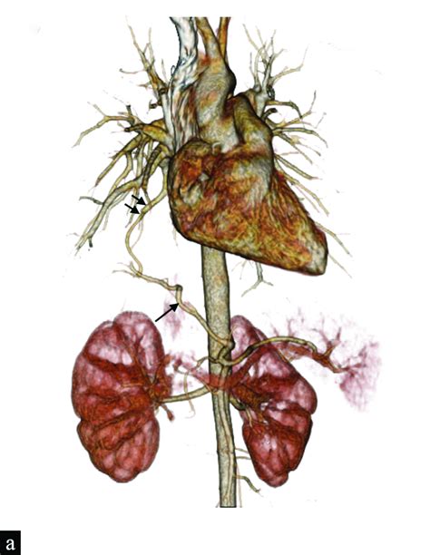 Successful Coil Embolization Of Pseudo Pulmonary Sequestration A
