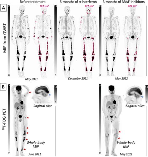 Maximal Intensity Projection Images Of QWBT And FDG PET Displayed With